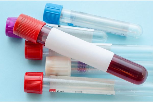 What Is the HIV RNA PCR Test and How Does It Work?